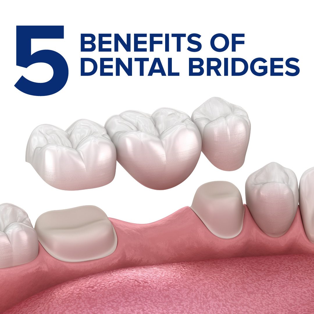 Dental Bridges in Savannah, GA | Christopher Comer, DMD