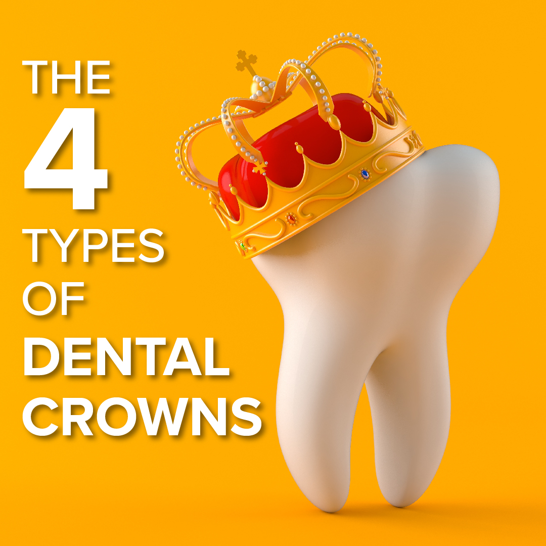 Dental Crowns | Christopher Comer, DMD LLC | Savannah, GA